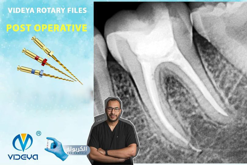 SINGLE VISIT ENDODONTIC TREATMENT_Knowledge_Huizhou Videya Technology ...
